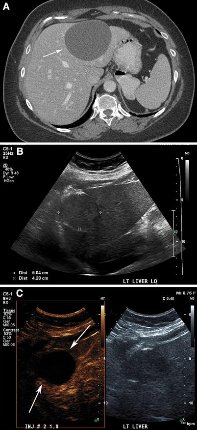 Contrast-enhanced ultrasound of benign liver lesions | SpringerLink
