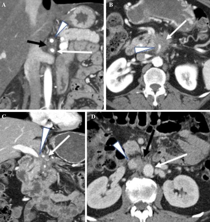 Staging of pancreatic cancer: resectable, borderline resectable, and ...