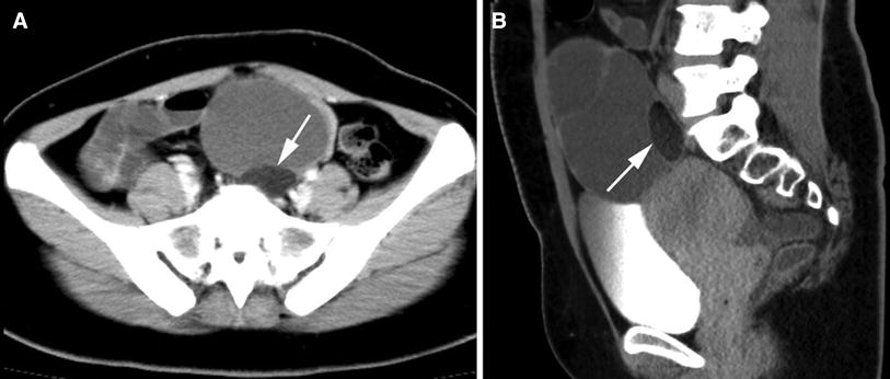 Ovarian collision tumors: imaging findings, pathological ...