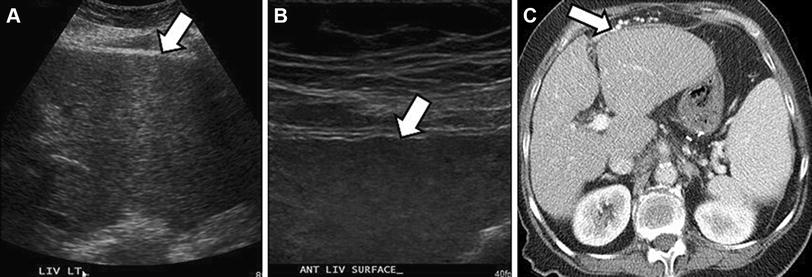 Cirrhosis and LI-RADS | SpringerLink