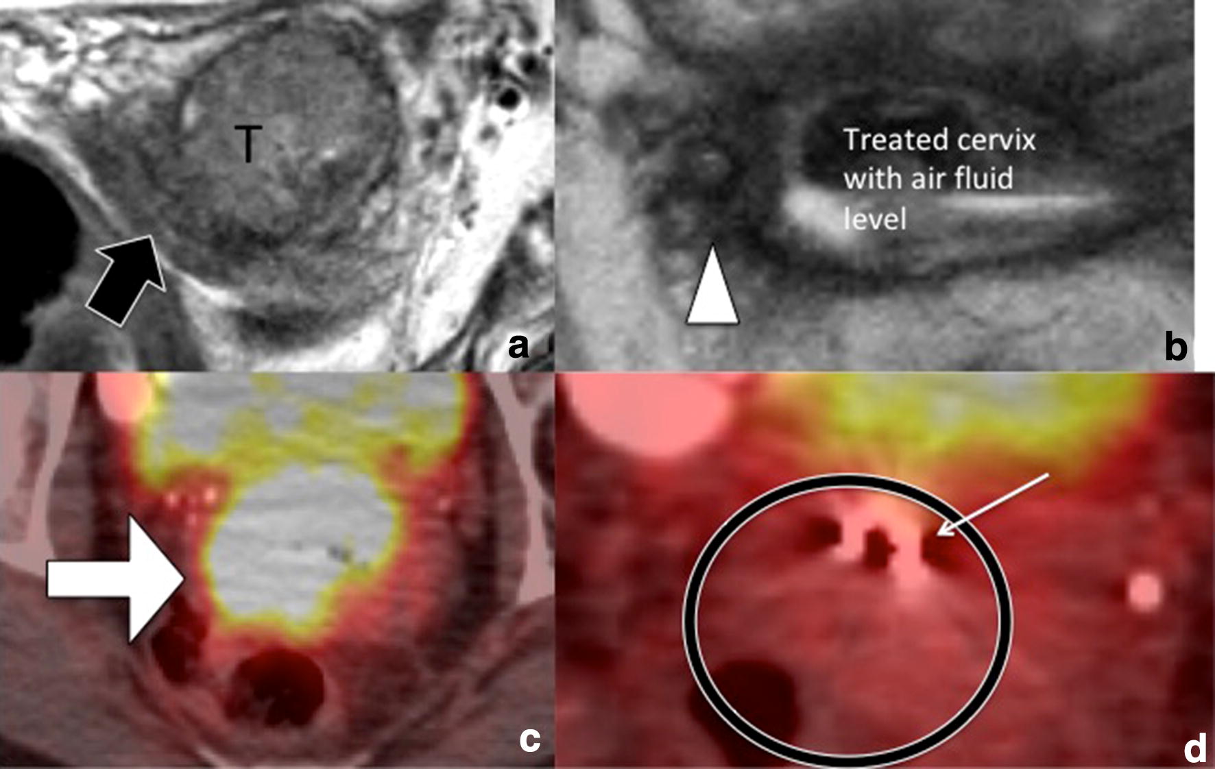 MRI of cervical cancer with a surgical perspective: staging, prognostic ...