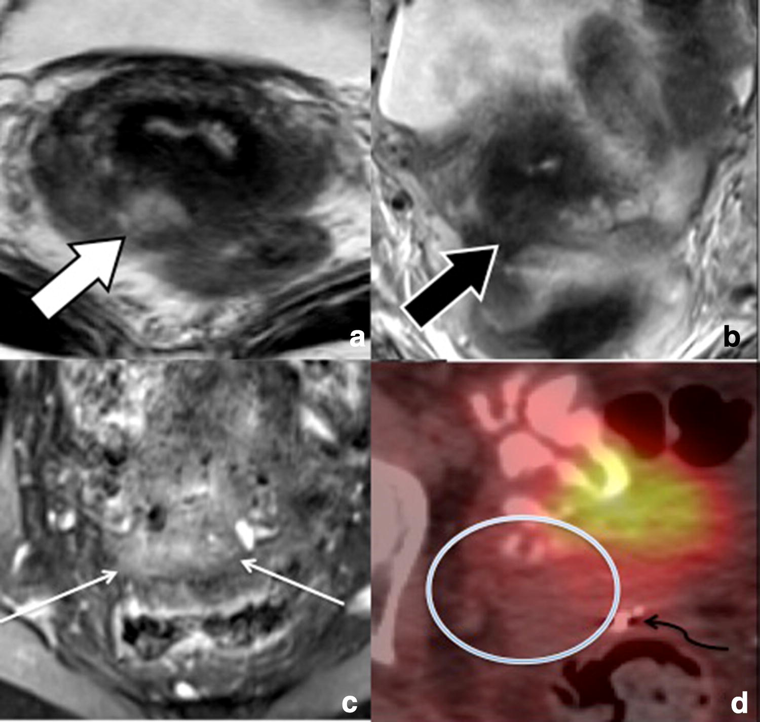MRI of cervical cancer with a surgical perspective: staging, prognostic ...