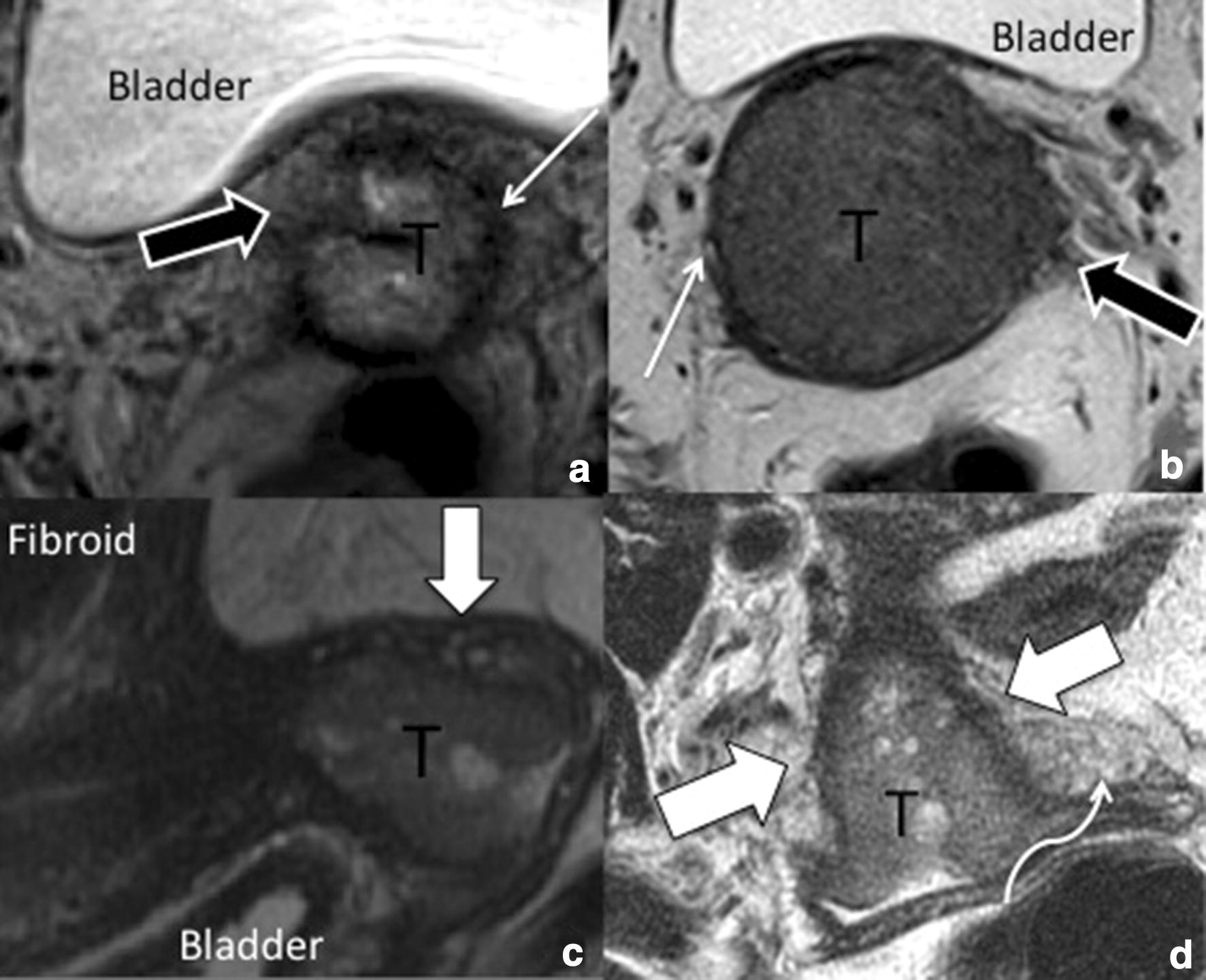 MRI of cervical cancer with a surgical perspective: staging, prognostic ...