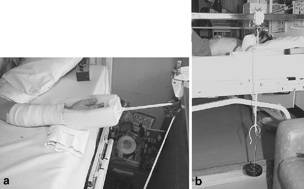 Management of grade III supracondylar fracture of the humerus by ...