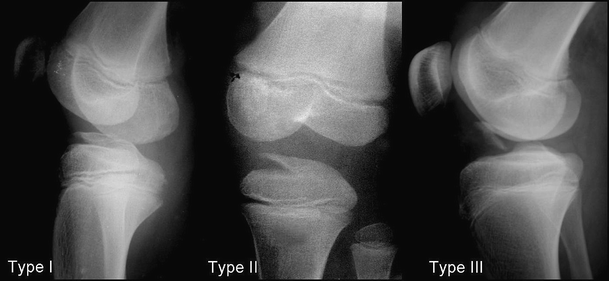 Clinical and radiological results of arthroscopically treated tibial ...