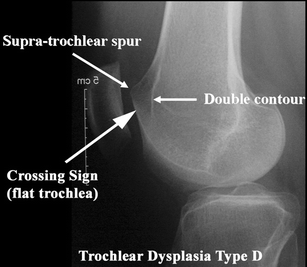 The sulcus deepening trochleoplasty—the Lyon’s procedure | SpringerLink