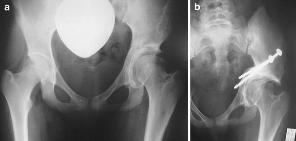 Chiari pelvic osteotomy in the treatment of adolescent hip disorders ...