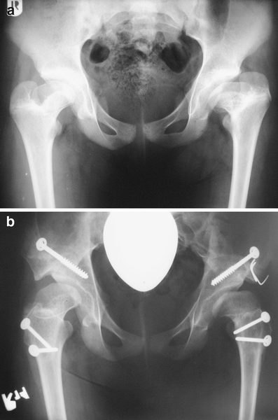 Chiari pelvic osteotomy in the treatment of adolescent hip disorders ...