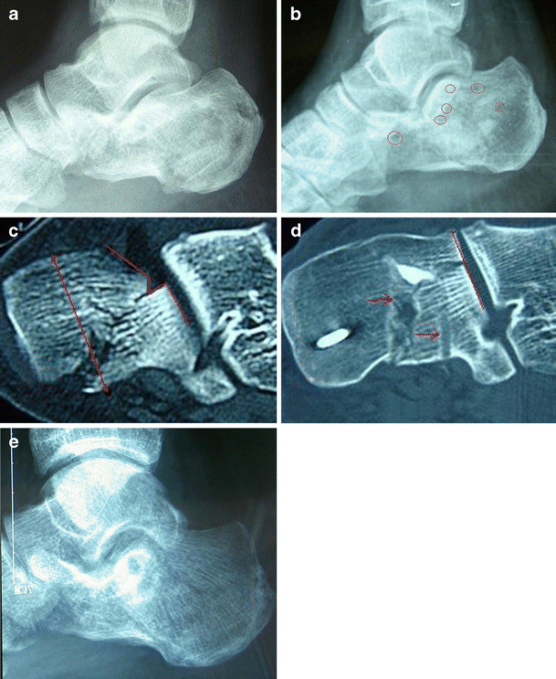 Surgical treatment of calcaneal fractures with bioabsorbable screws ...
