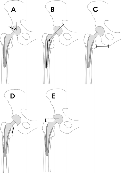 Dislocation of hip hemiarthroplasty following posterolateral surgical ...