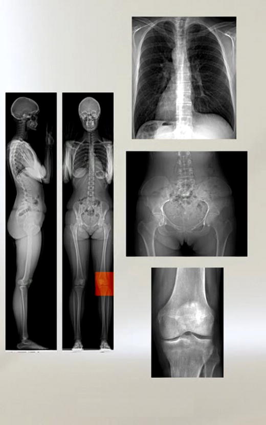 The EOS™ imaging system and its uses in daily orthopaedic practice ...