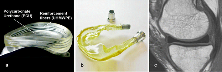 Synthetic meniscus replacement: a review | SpringerLink