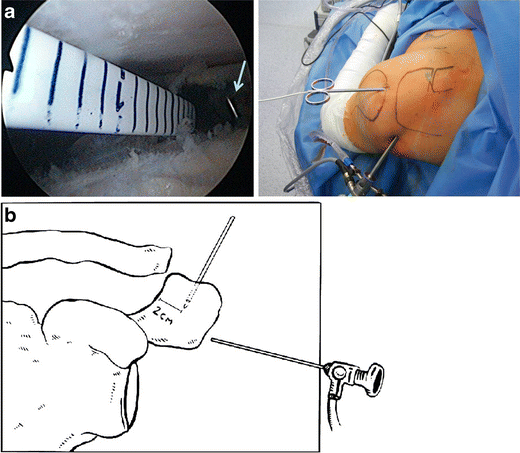 Arthroscopic-assisted hook plate fixation for acromioclavicular joint ...