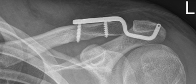 Arthroscopic-assisted hook plate fixation for acromioclavicular joint ...