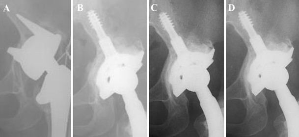 Modular acetabular reconstructive cup in acetabular revision total hip ...