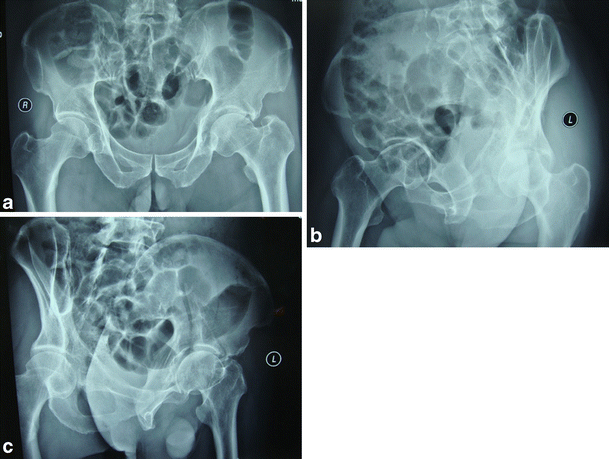 Newly modified Stoppa approach for acetabular fractures | SpringerLink