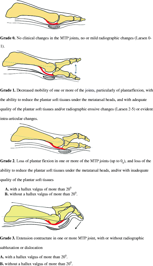 Rheumatoid forefoot deformity: pathophysiology, evaluation and ...