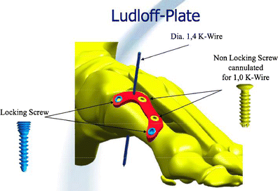 The Ludloff osteotomy: a review of current concepts | SpringerLink