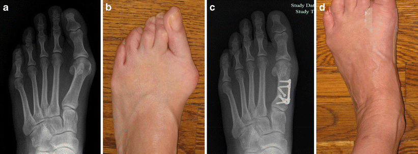 The Ludloff osteotomy: a review of current concepts | SpringerLink
