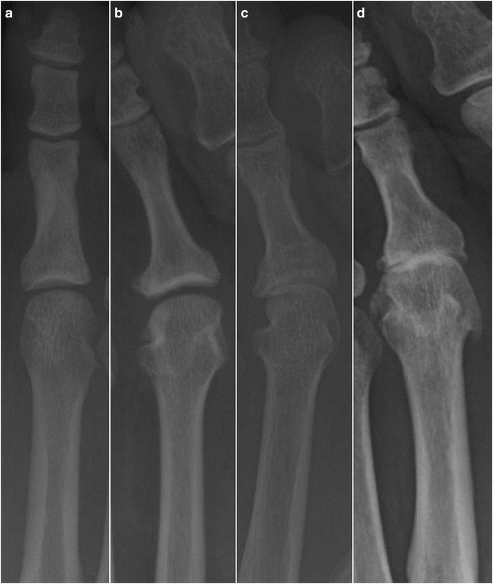 Degenerative osteoarthritis of the second metatarsophalangeal joint ...