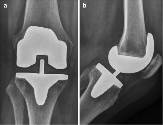 Does high flexion after total knee replacement really improve our ...