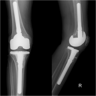 Comparison of quadriceps snip and tibial tubercle osteotomy in revision ...