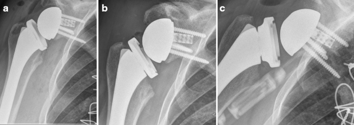 Glenosphere disengagement in a reverse total shoulder arthroplasty with ...