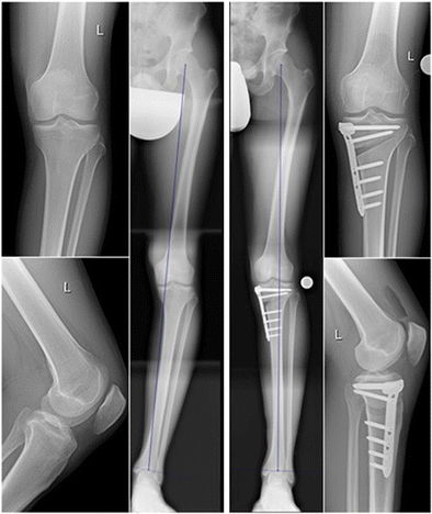 Return to work and sporting activities after high tibial osteotomy ...