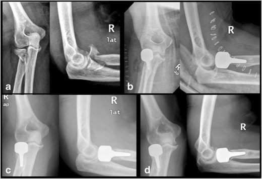 Open reduction and internal fixation versus radial head arthroplasty in ...