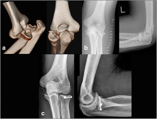 Open reduction and internal fixation versus radial head arthroplasty in ...