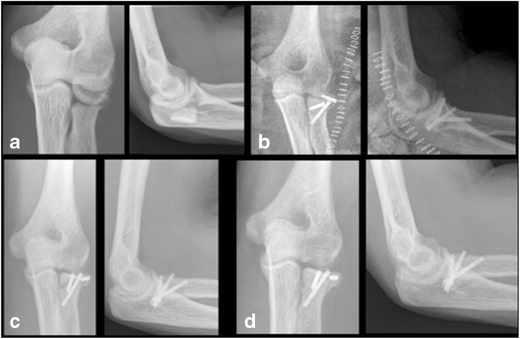 Open reduction and internal fixation versus radial head arthroplasty in ...