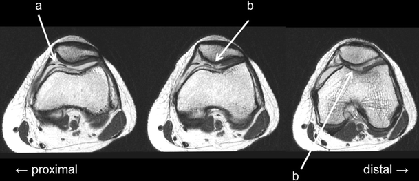 Characteristics of medial plica syndrome complicated with cartilage ...