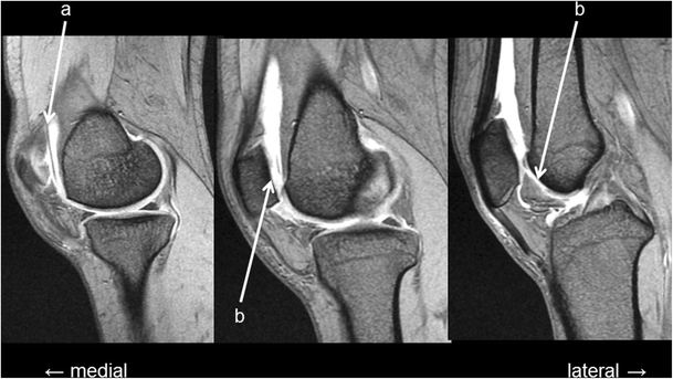 Characteristics of medial plica syndrome complicated with cartilage ...
