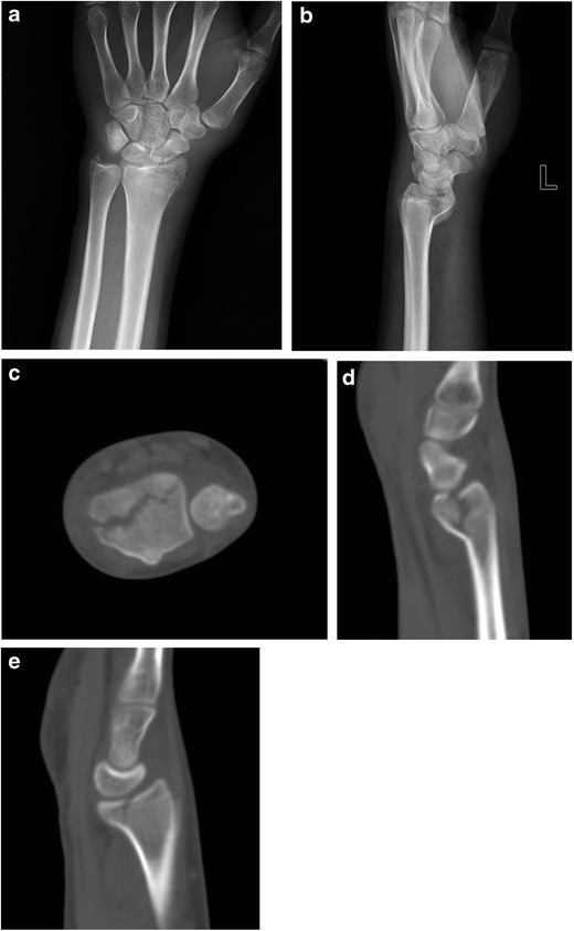 A classification and grading system for Barton fractures | SpringerLink