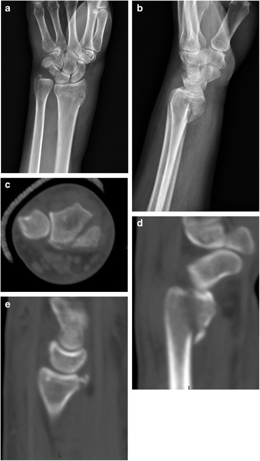 A classification and grading system for Barton fractures | SpringerLink