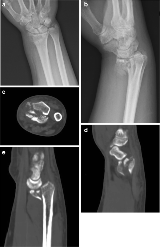 A classification and grading system for Barton fractures | SpringerLink