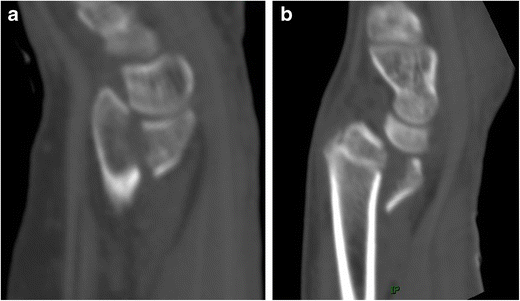 A classification and grading system for Barton fractures | SpringerLink