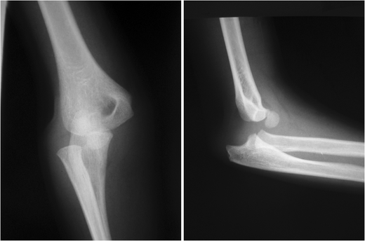 Pure elbow dislocation in the paediatric age group | SpringerLink