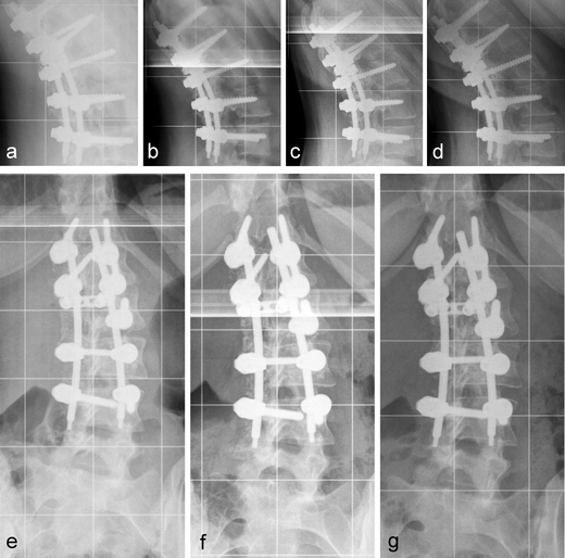 Natural hydroxyapatite as a bone graft extender for posterolateral ...