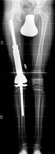 Non-invasive expandable prosthesis in musculoskeletal oncology ...