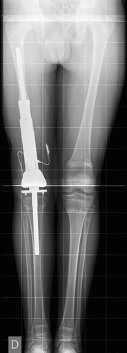 Non-invasive expandable prosthesis in musculoskeletal oncology ...