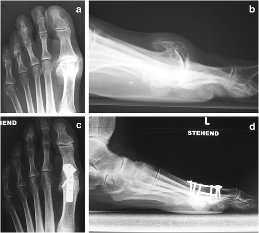 Long-term outcome of first metatarsophalangeal joint fusion in the ...