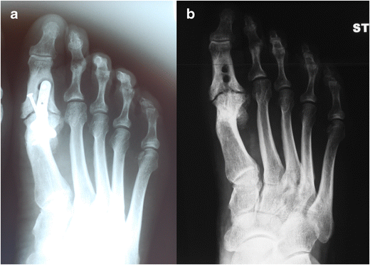Long-term outcome of first metatarsophalangeal joint fusion in the ...