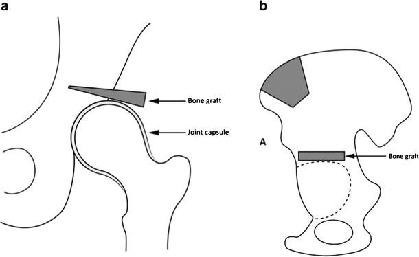 Long-term results of a modified Spitzy shelf operation for residual hip ...