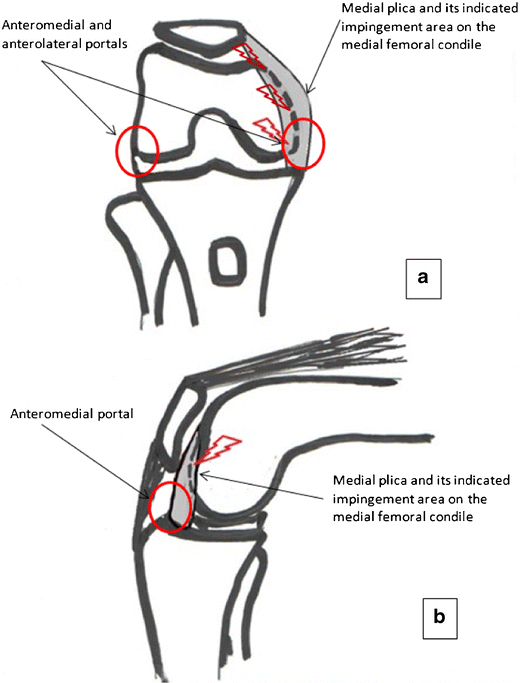 Long term results after arthroscopic resection of medial plicae of the ...
