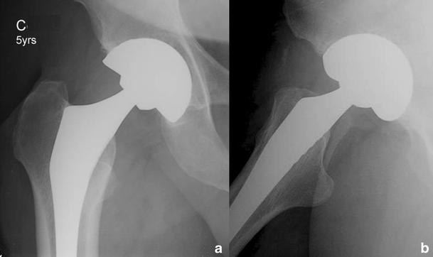 Early experience with dual mobility acetabular systems featuring highly ...