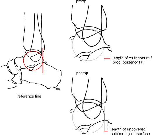 Painful stress reaction in the posterior subtalar joint after resection ...