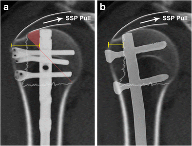 Biomechanical evaluation of straight antegrade nailing in proximal ...