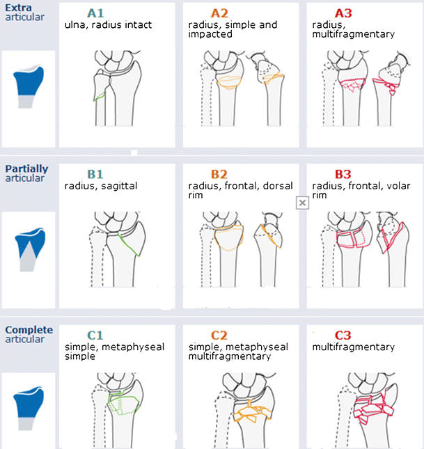 Efficiency of fragment specific fixation plates in the treatment of ...