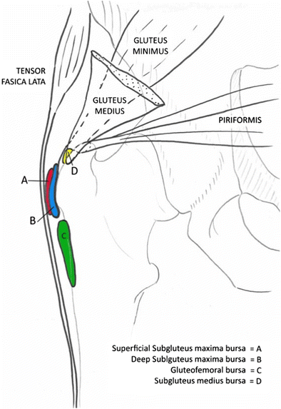 Surgery for greater trochanteric pain syndrome after total hip ...